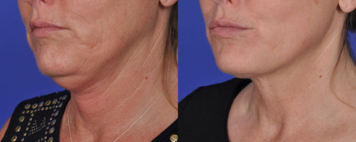 B&A - Submental Fold 2 | Teshima Plastic Surgery